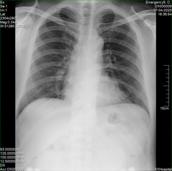 Mobile X Ray DR system x-ray machine for patient delivery transfer ...